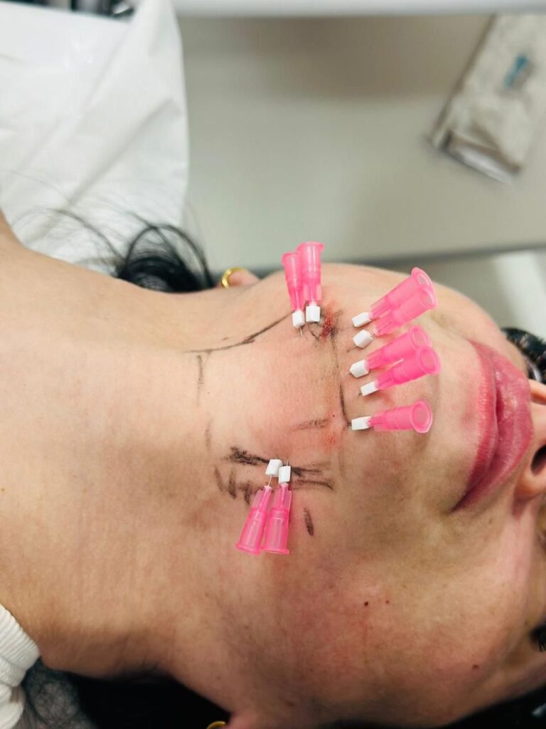 Fios de PDO - Clínica Priscila Werneck